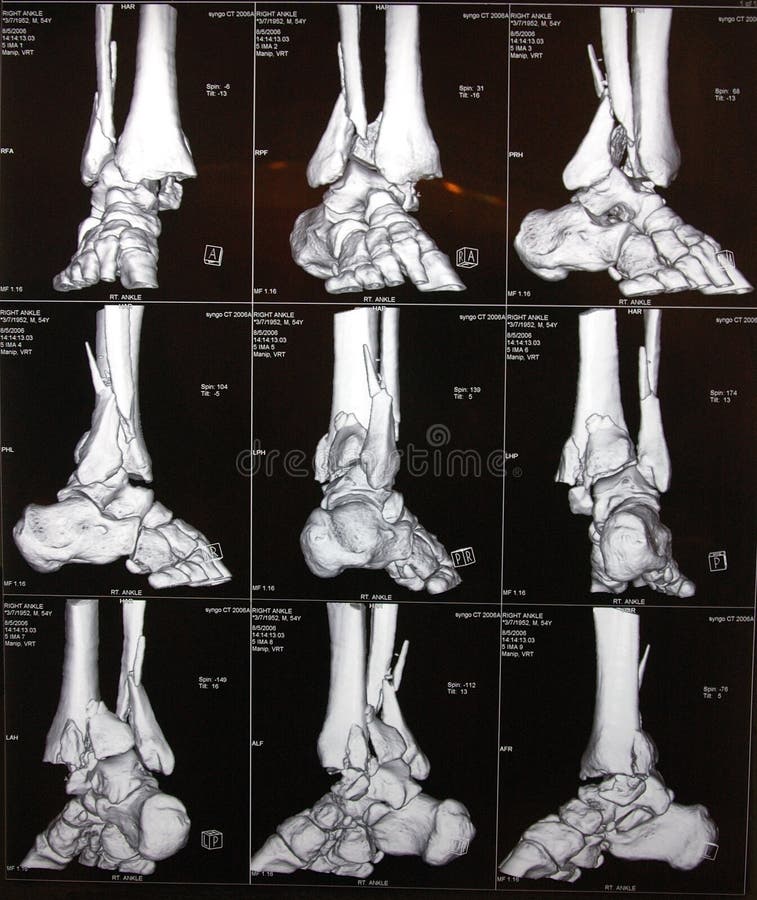 Right ankle CT stock image. Image of parts, doctor, skeleton - 1156825