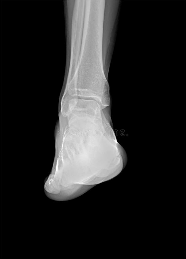 Right Ankle X-ray. Back Scan Stock Image - Image of heels, anatomy ...
