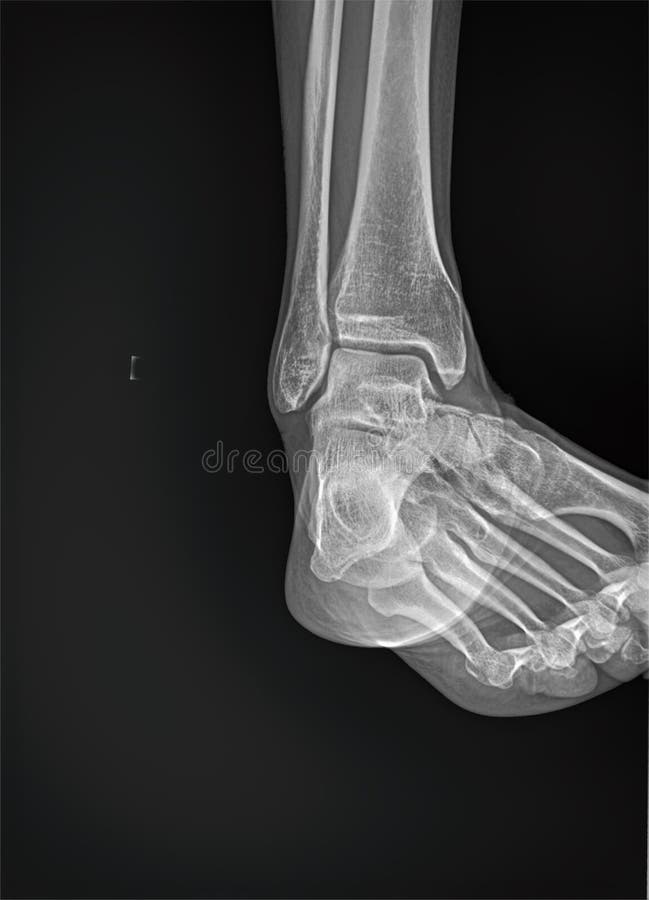 Right Ankle X-ray. Downward Scan Stock Photo - Image of medicine, xray ...