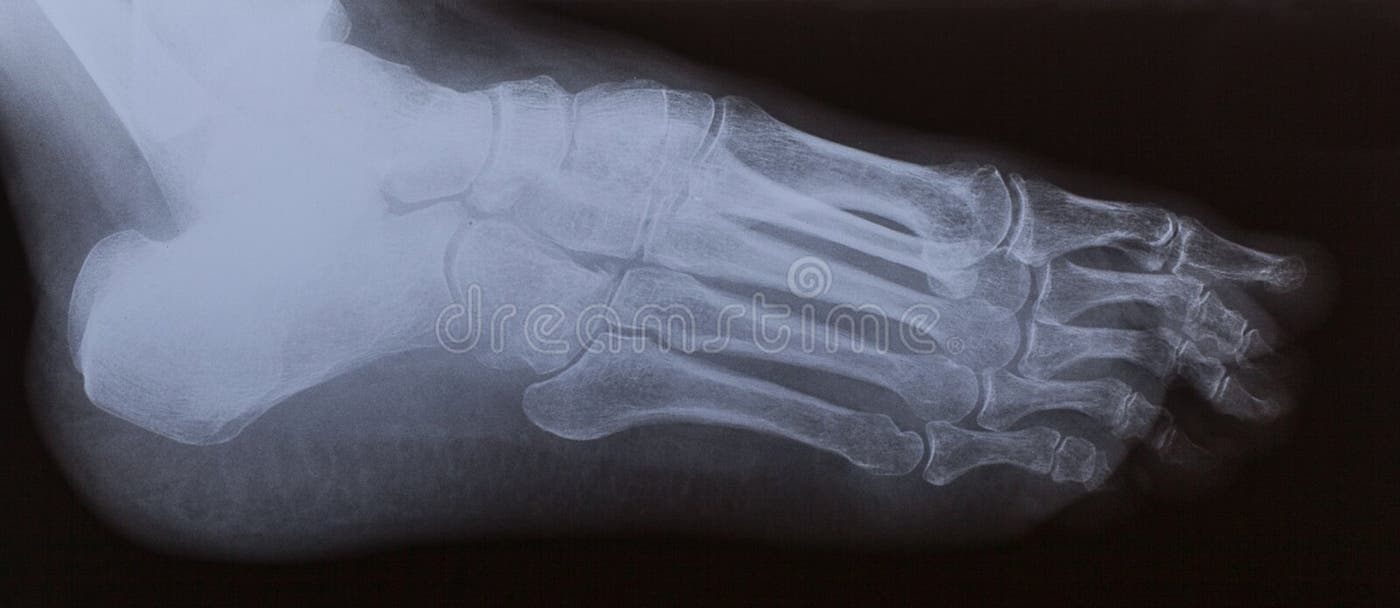 137 Xray Foot Side Stock Photos - Free & Royalty-Free Stock Photos from ...
