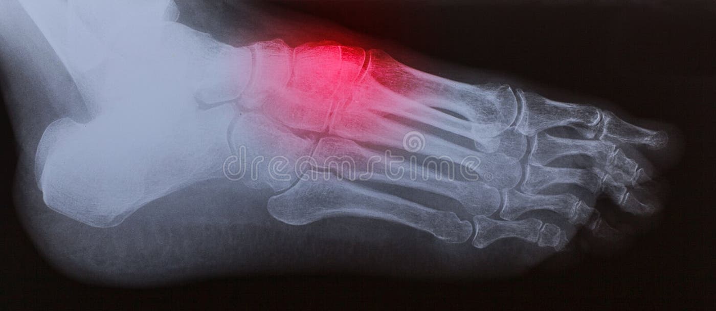 Human Right Leg Side View Bone Stock Photos - Free & Royalty-Free Stock ...