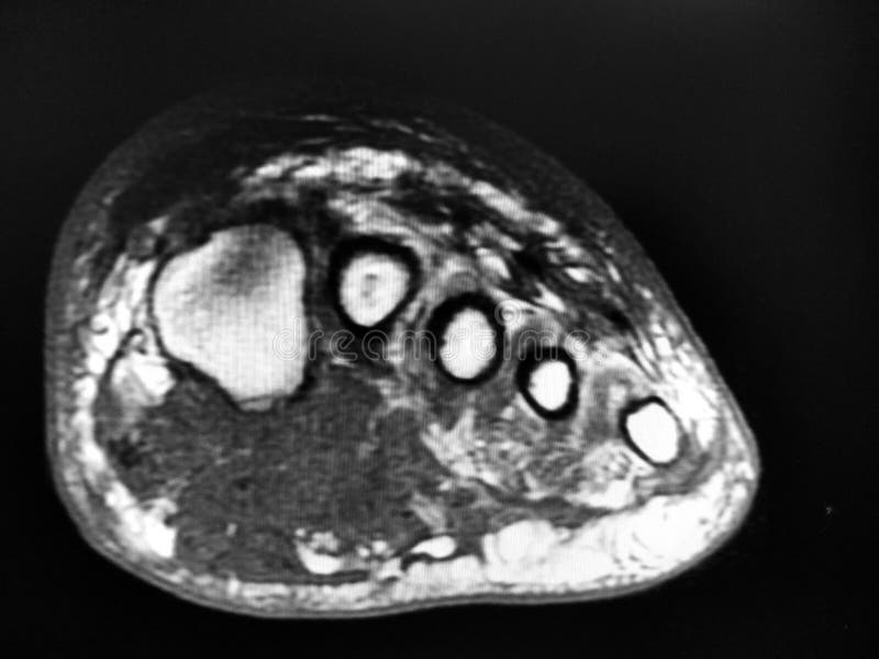 Foot Xray Showing Soft Tissue Gas in Patient with Necrotizing ...