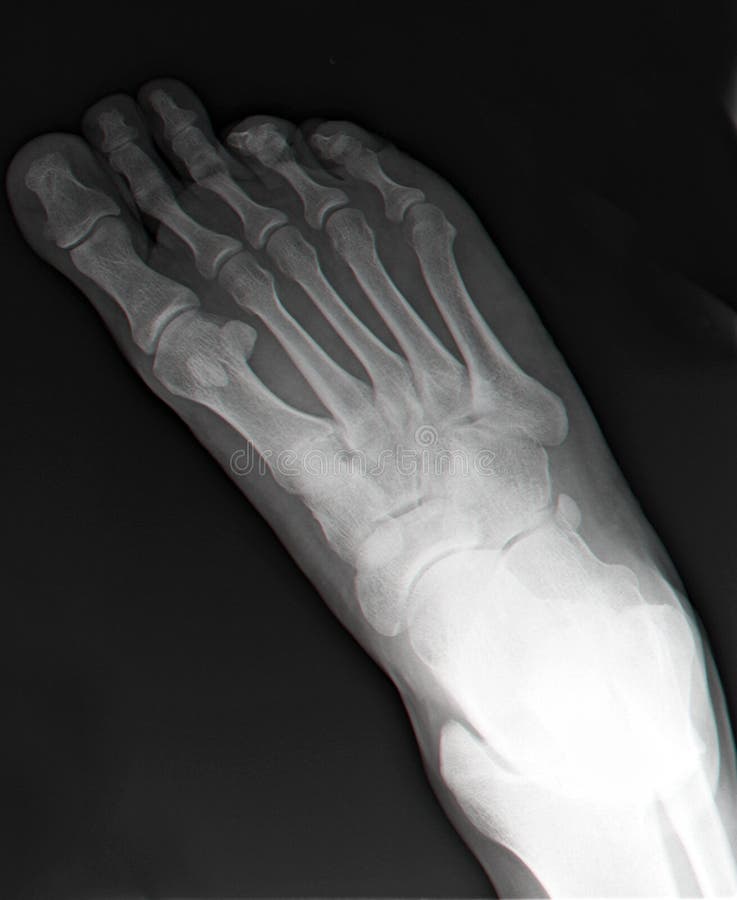 Right foot x-ray#2 stock image. Image of foot, healthcare - 2783805