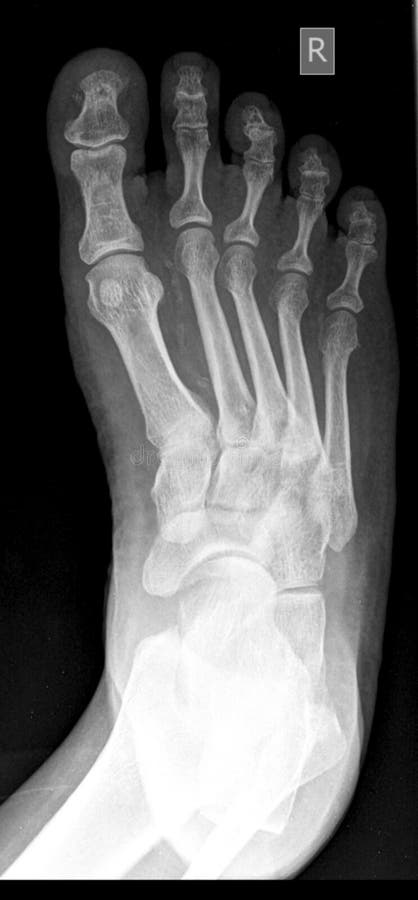 Right Foot X Ray Image AP Position with Toes Stock Photo - Image of ...