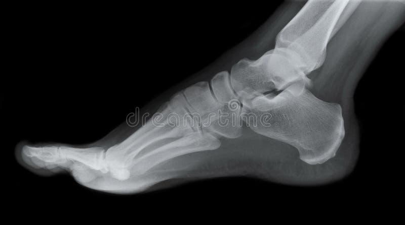 Right Foot Side X-ray stock image. Image of bone, hospital - 23580309