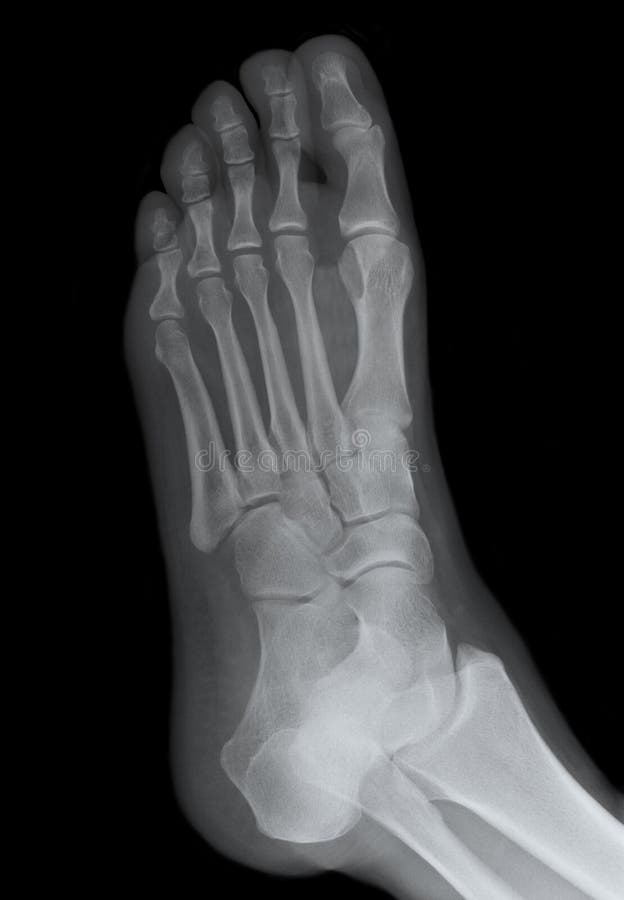 Right Foot Side X-ray stock image. Image of toes, right - 23691317
