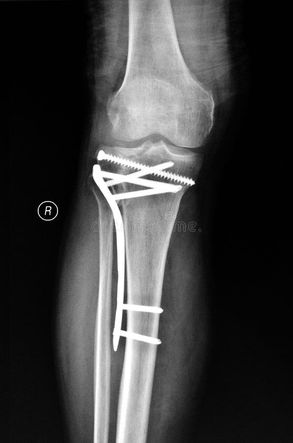 Tibia Platform Stock Photos - Free & Royalty-Free Stock Photos from ...