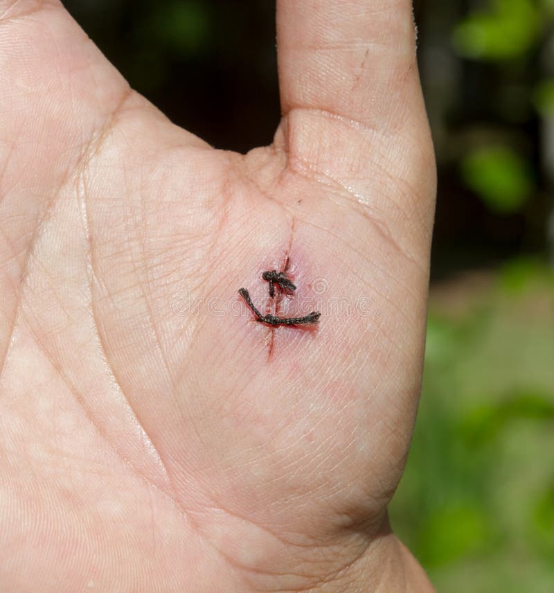 Right hand injury. stock photo. Image of surgery, human - 46800872