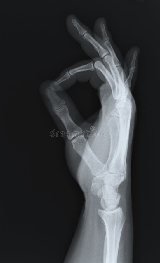 Right Hand Ok X-ray stock photo. Image of black, bones - 23545620