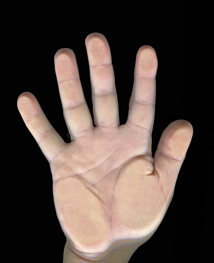 Cyanotic Hands or Peripheral Cyanosis or Blue Hands at Asian Old Woman ...