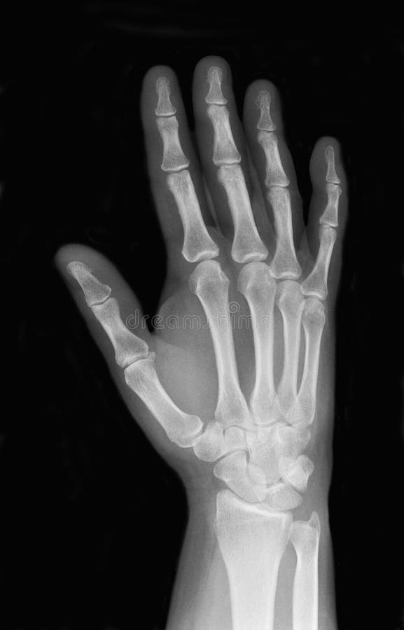 Normal Hand X Ray