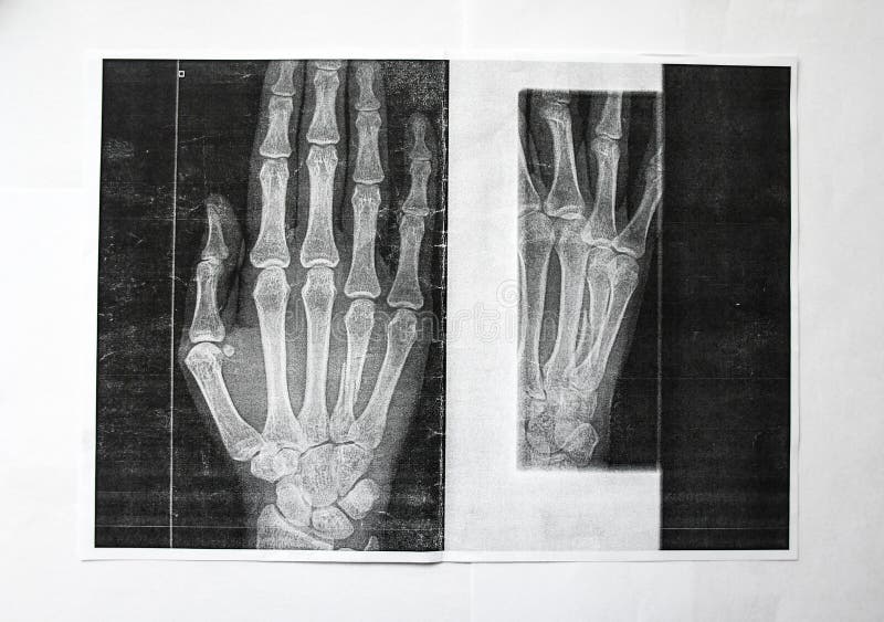 Right hand x ray image stock photo. Image of anatomy - 221862304