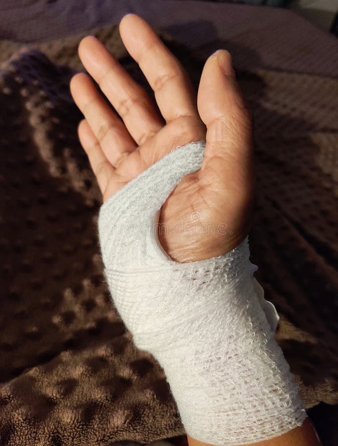 A Right Hand in Splint after Surgery. Stock Image - Image of blood ...