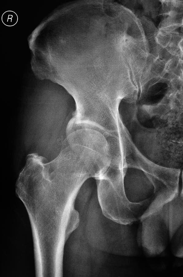 Right hip X-ray pictures stock image. Image of medical - 36753605