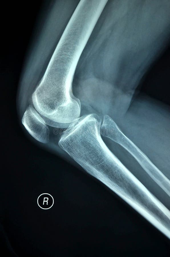 Right Knee Joint X-ray Photograph Stock Image - Image of thighs ...