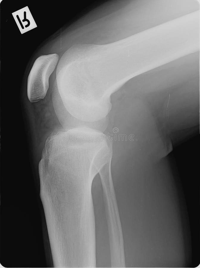 Right knee X-Ray scan stock photo. Image of negative - 179411642