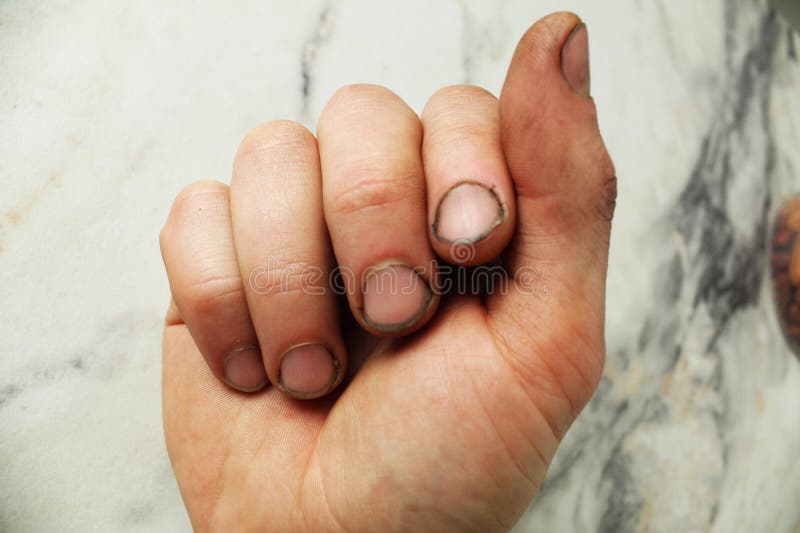 Right Male Hand with Dirty Nails Close-up. Hand Care Stock Photo ...