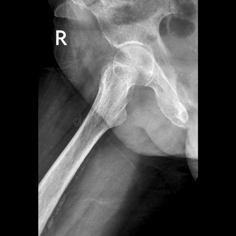 Hip Joint X-ray Image Lateral View Stock Image - Image of healthcare ...