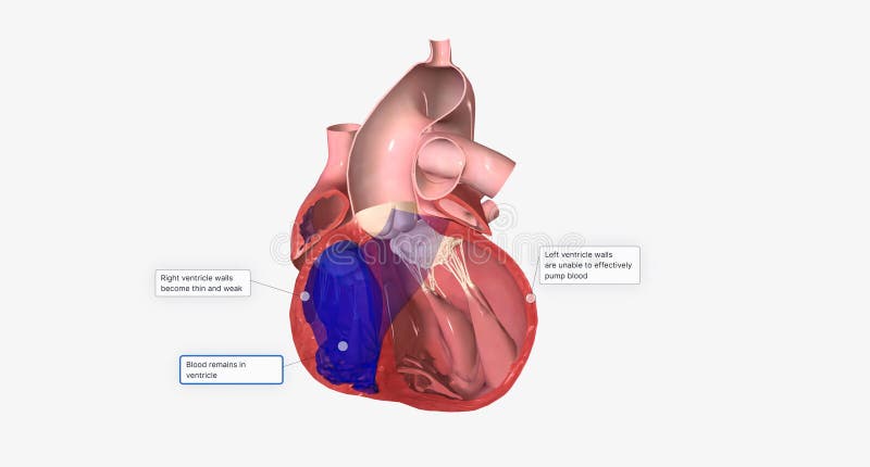 Right-sided Heart Failure is Commonly Caused by Left-sided Heart ...