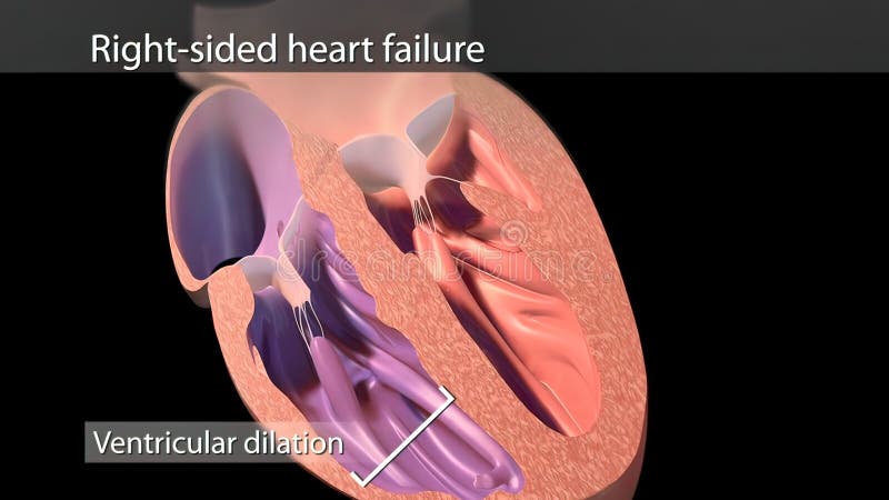 Right sided heart failure stock illustration. Illustration of adult ...