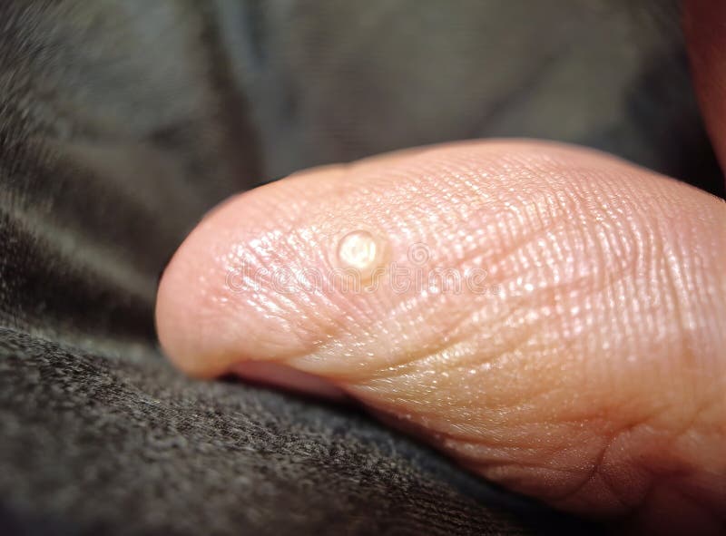 273 Nose Wart Stock Photos - Free & Royalty-Free Stock Photos from ...