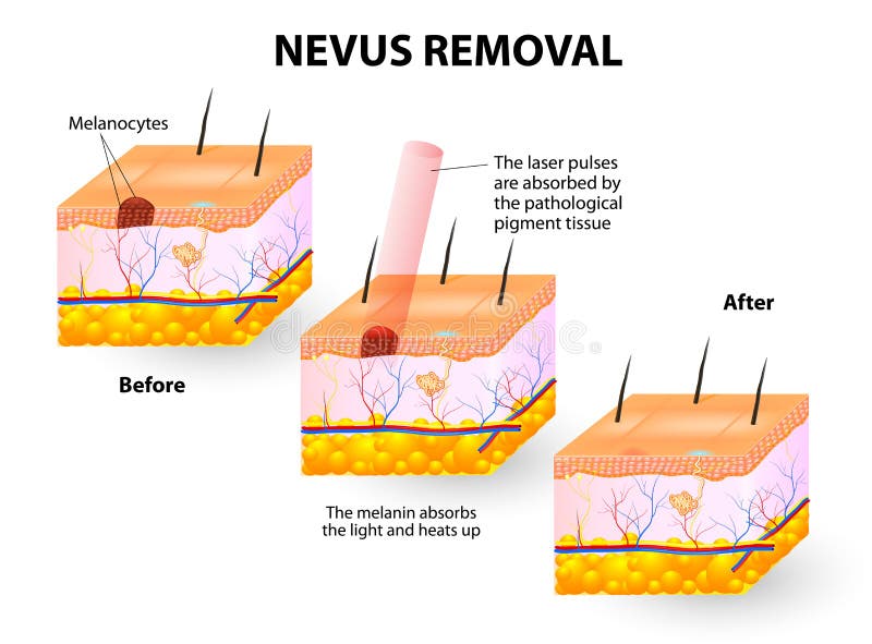 La Struttura Del Neo La Struttura Delle Talpe Sulla Pelle Infographics ...