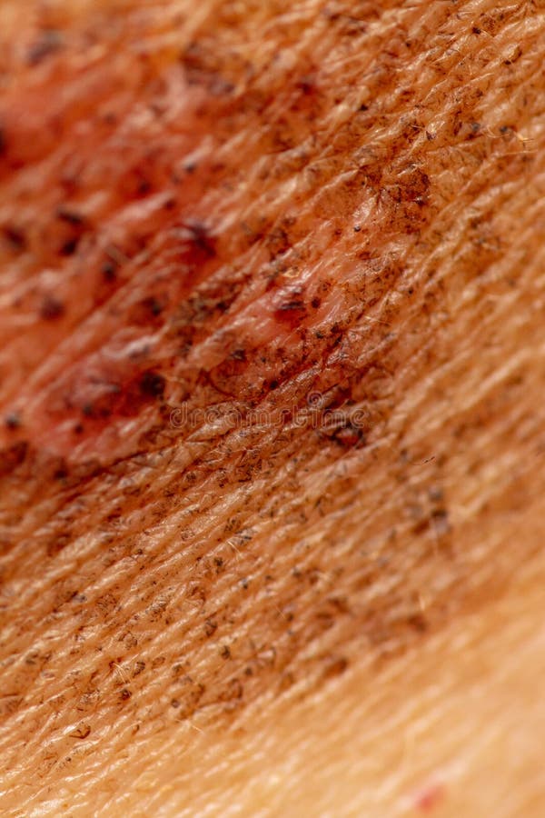 137 Ringworm Human Skin Photos - Free & Royalty-Free Stock Photos from ...