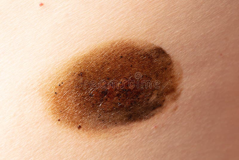 Ringworm on Human Skin As a Background. Macro. Stock Image - Image of ...