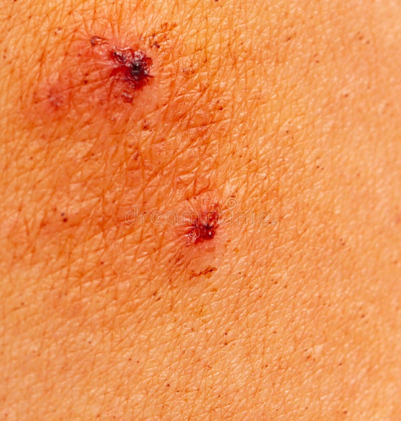 Ringworm on Human Skin As a Background. Macro. Stock Photo - Image of ...