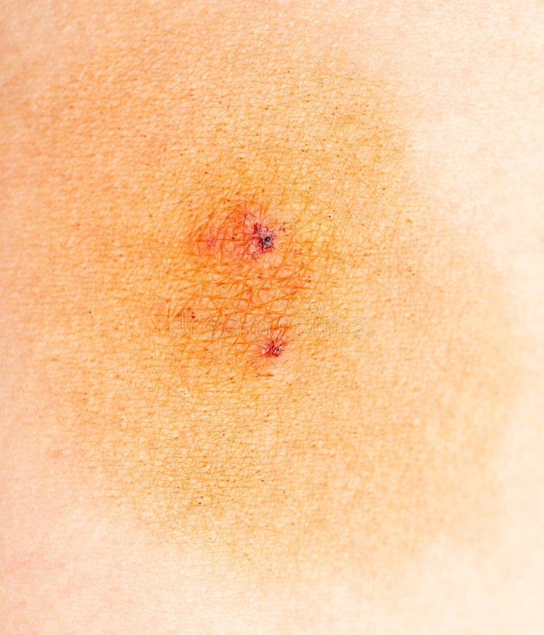 Ringworm on Human Skin As a Background. Macro. Stock Photo - Image of ...