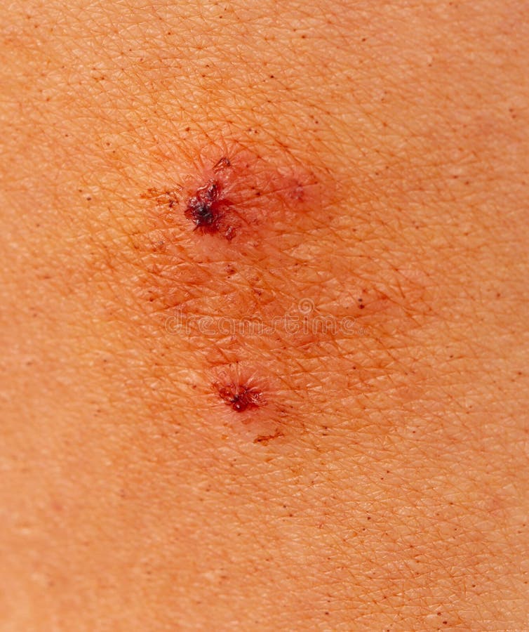 Ringworm on Human Skin As a Background. Macro. Stock Image - Image of ...