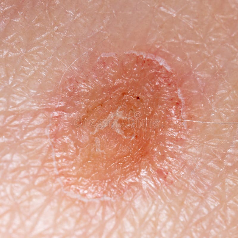 Ringworm on human skin stock photo. Image of healthcare - 101157870