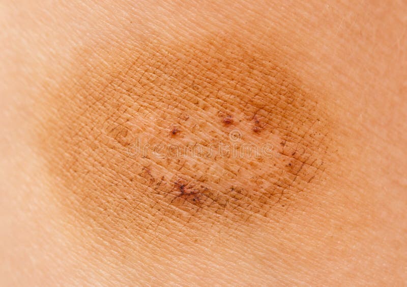 Ringworm on the Skin As Background Stock Image - Image of ointment ...