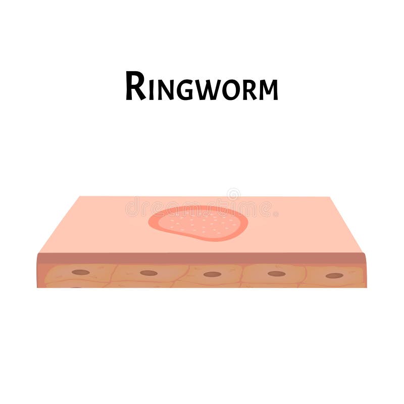 Ringworm Vector Illustration. Labeled Fungal Skin Infection Example ...