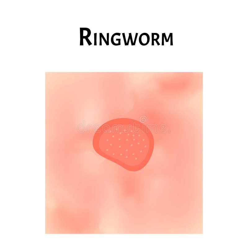 Ringworm on the Skin. Vector Illustration on Isolated Background Stock ...