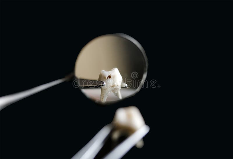 Ripped Out a Rotten Tooth in the Forceps is Reflected in Dental Stock ...