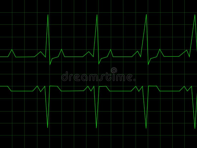 Ritmo normal del corazón stock de ilustración. Ilustración de médico ...