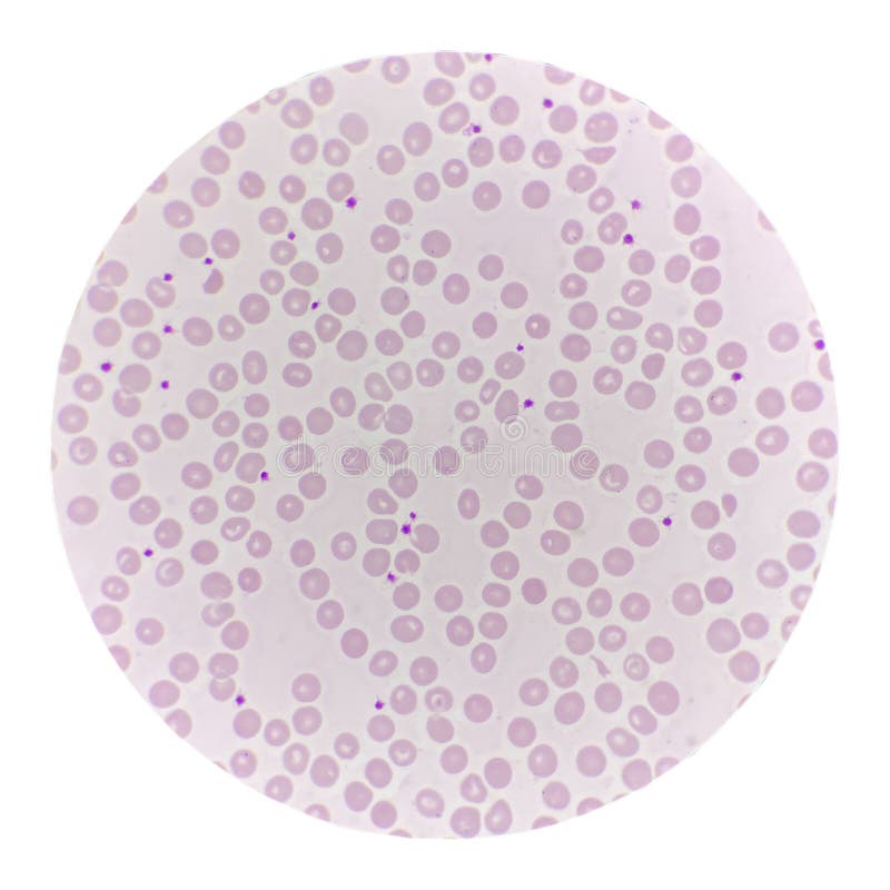 Rode Bloedcel Met Bloedplaatjes in Bloeduitstrijkjes Stock Illustratie ...