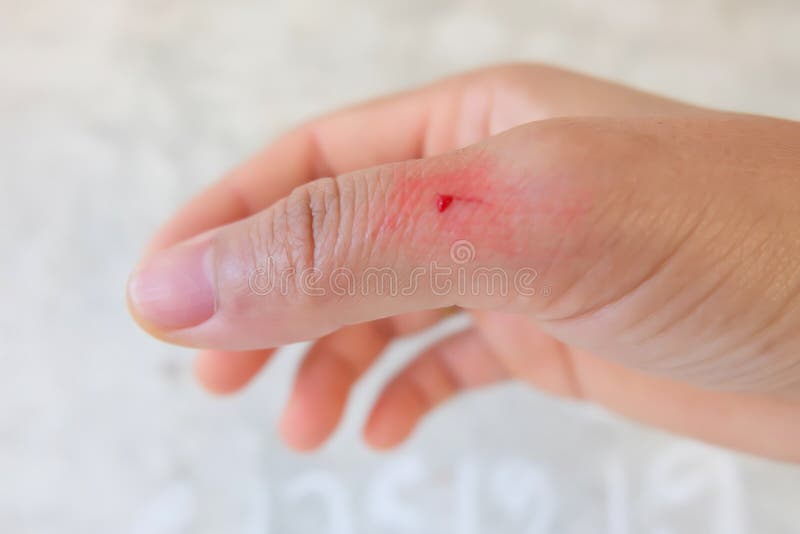 Rode Wond in Vinger Op Blauwe Achtergrond Stock Afbeelding - Image of ...
