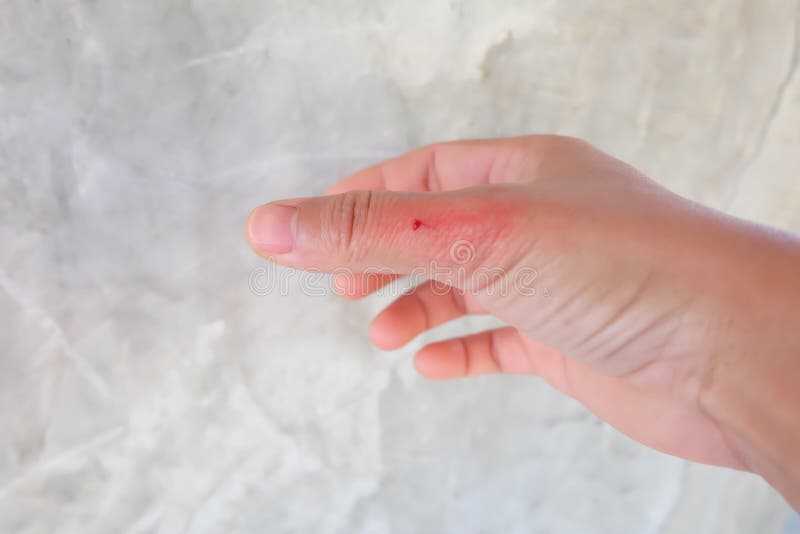 Wond Op Vinger De Wijsvinger Met Gekronkelde Besnoeiing, Brandwond En ...