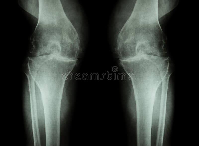 Rodilla De La Osteoartritis (rodilla) Del OA (radiografía De La ... Rodilla De La Osteoartritis (rodilla) Del OA (radiografía De La ...