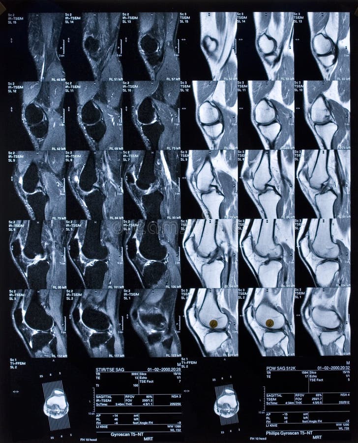 Imágenes De Resonancia Magnética De La Tomografía (MRT) De La Rodilla ...
