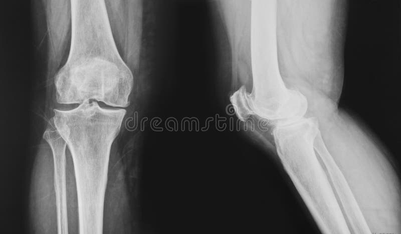Radiografía De Rodilla Normal Foto de archivo - Imagen de roentgen ...