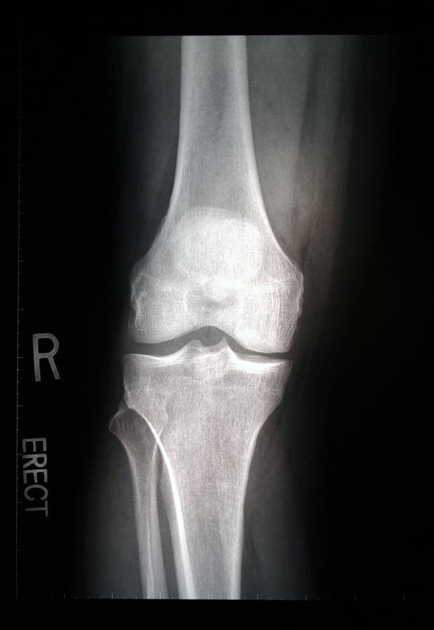 Radiografía de la rodilla imagen de archivo. Imagen de rodillas - 147463