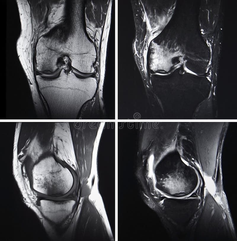Radiografía Normal De La Rodilla Imagen de archivo - Imagen de cuadro ...