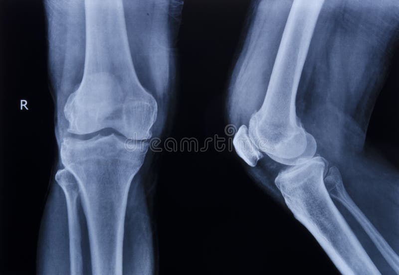 Radiografía Normal De La Rodilla Foto de archivo - Imagen de rodilla ...