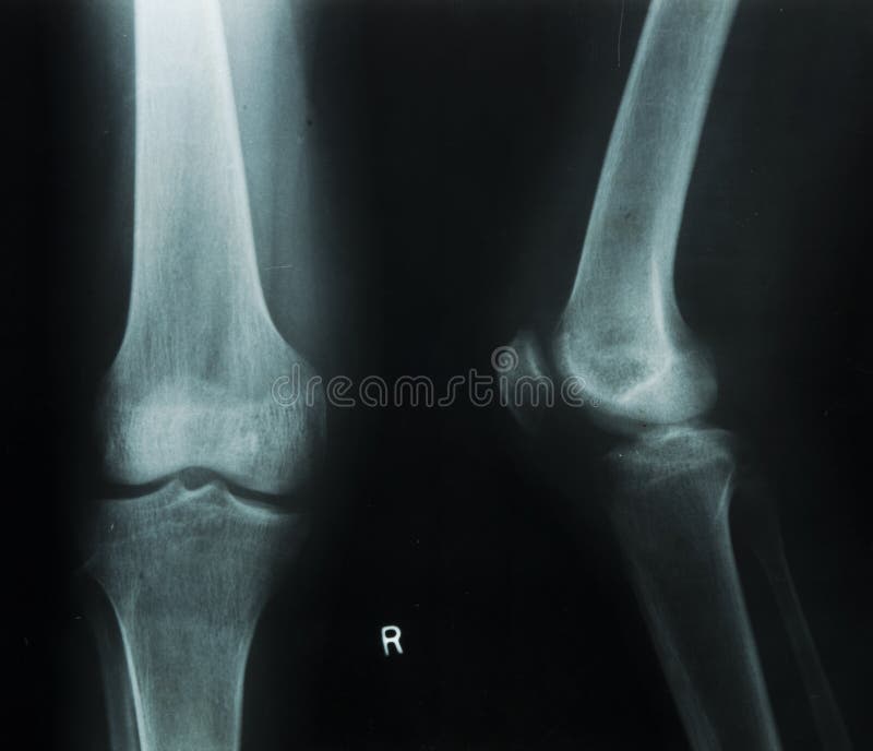 Radiografía Normal De La Rodilla Foto de archivo - Imagen de rodilla ...