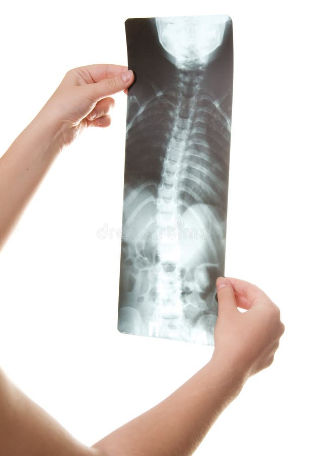 Roentgen stock image. Image of thorax, medicine, diagnostics - 9315731