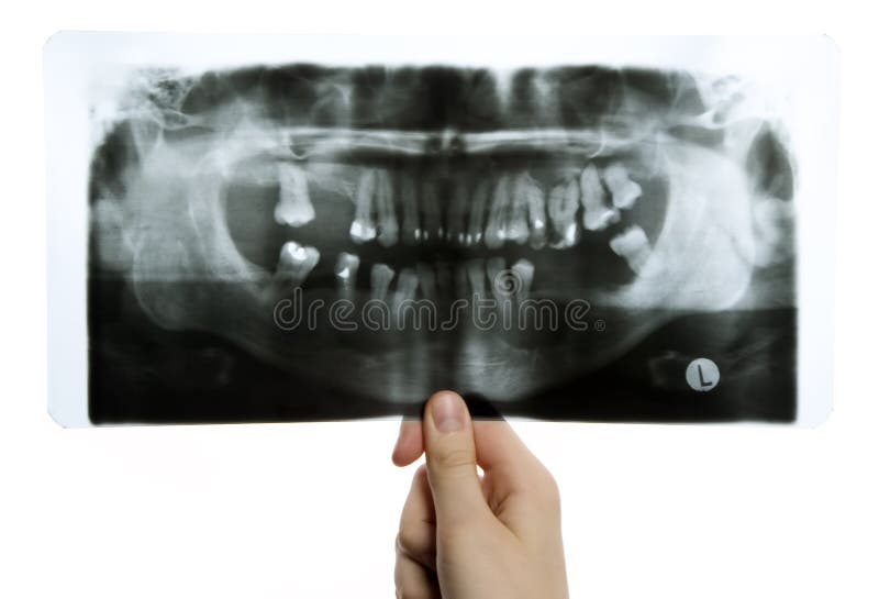 Roentgen photo of teeth stock image. Image of roentgen - 18624379