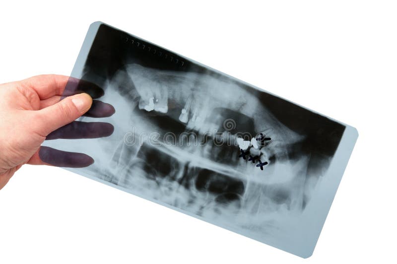 Roentgenogram stock photo. Image of isolated, surgeon - 32291214